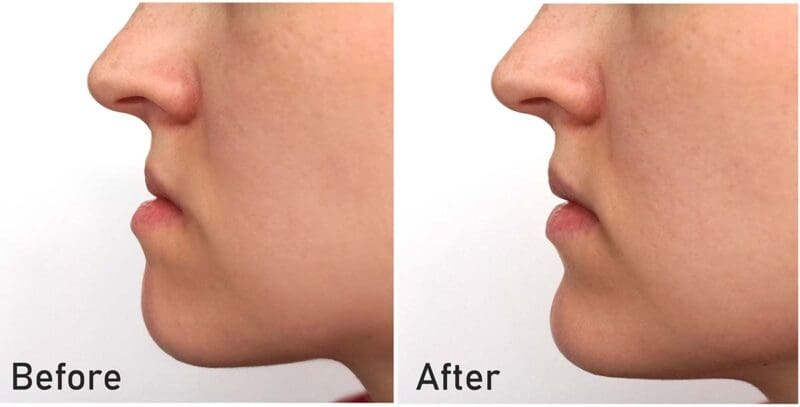 Can Braces Fix Jawline and Improve Your Chin? - Elara Orthodontics Can Braces Fix Jawline and Improve Your Chin? - Elara Orthodontics